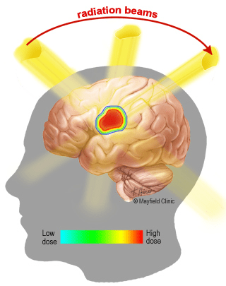 Stereotactic Radiosurgery (SRS) | AARO SG