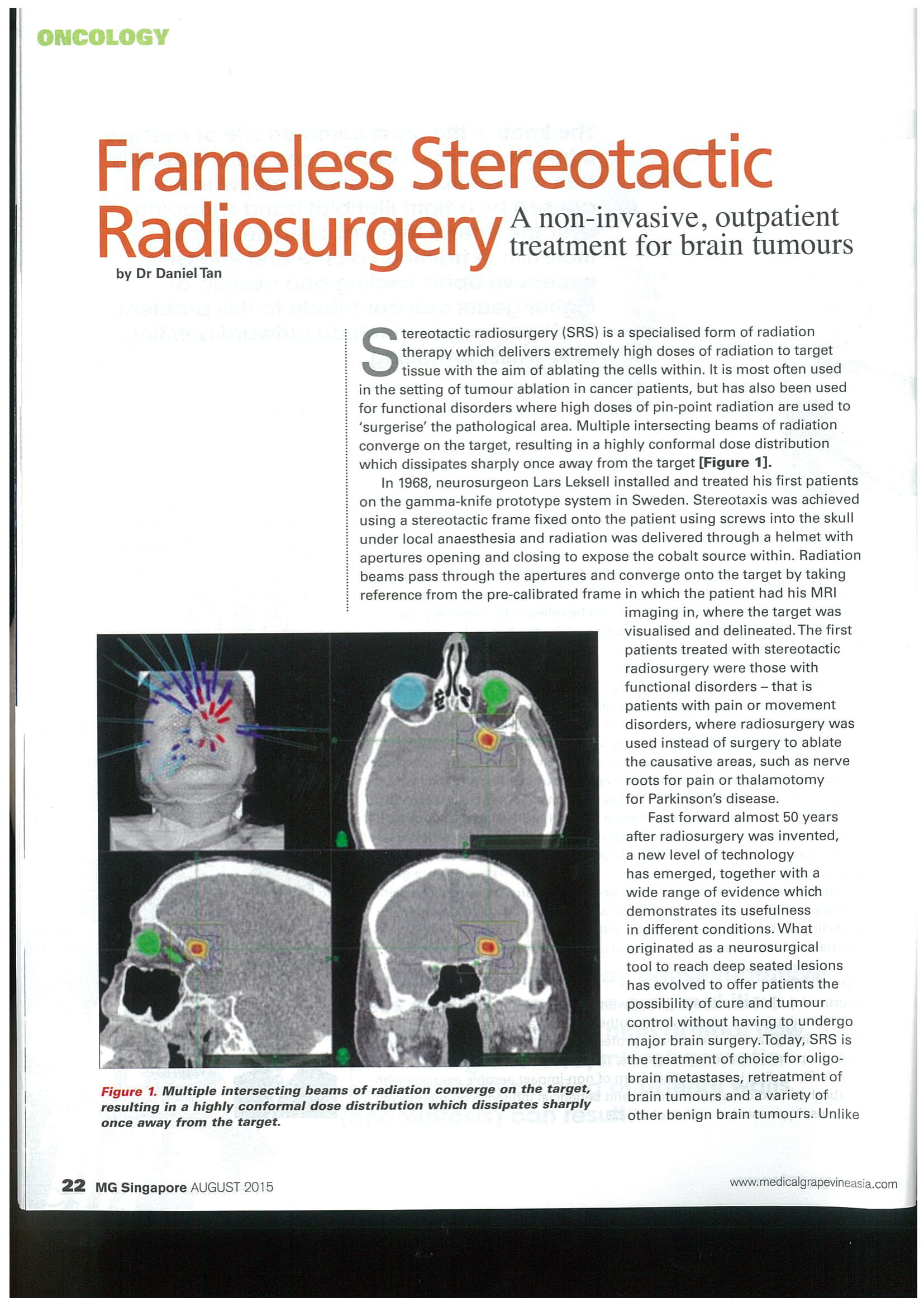 Medical Grapevine Asia: Frameless Stereotactic Radiosurgery