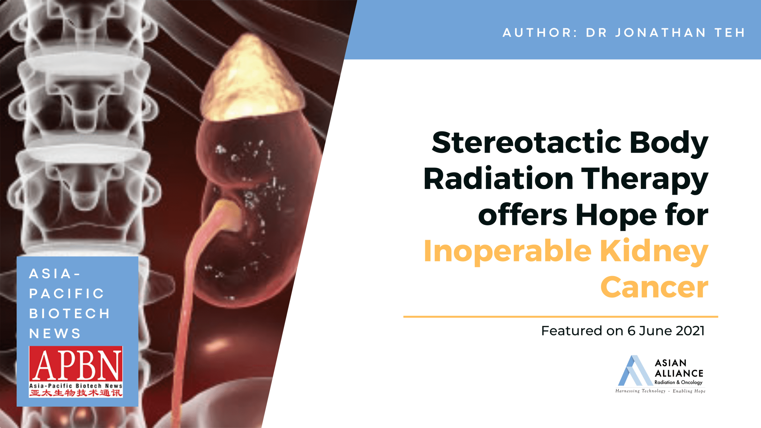 APBN: SBRT offers hope for Inoperable Kidney Cancer | AARO