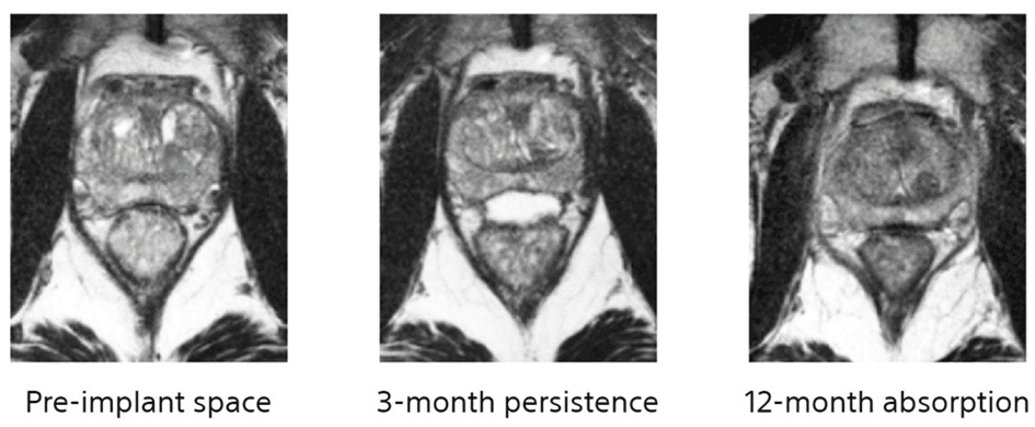 Prostate Cancer | Symptoms, Diagnosis, Treatment | AARO SG