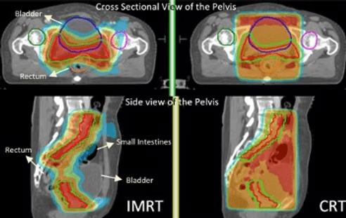Early Stage | Asian Alliance Radiation & Oncology