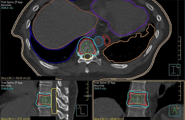 stage-4-prostate | Asian Alliance Radiation & Oncology