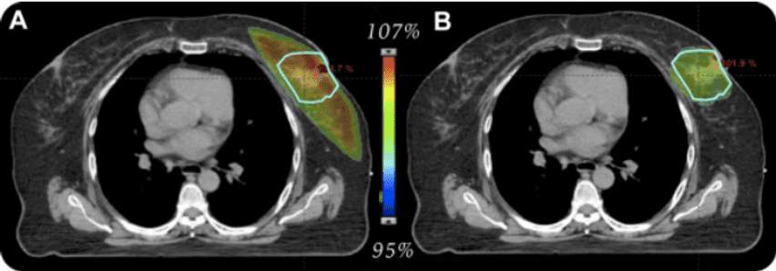 imrt | Asian Alliance Radiation & Oncology