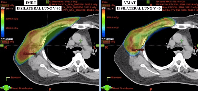 Vmat | Asian Alliance Radiation & Oncology