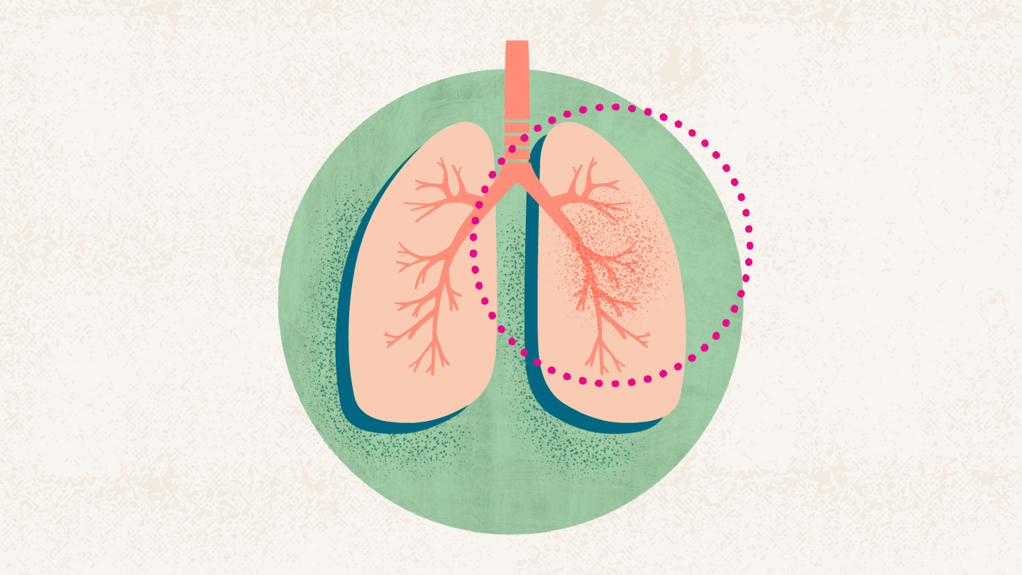 Lung Cancer: Treatment Options for Stage 3 and 4 Patients | AARO