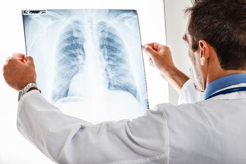 Understanding Lung Cancer Stages: From Diagnosis to Treatment | AARO