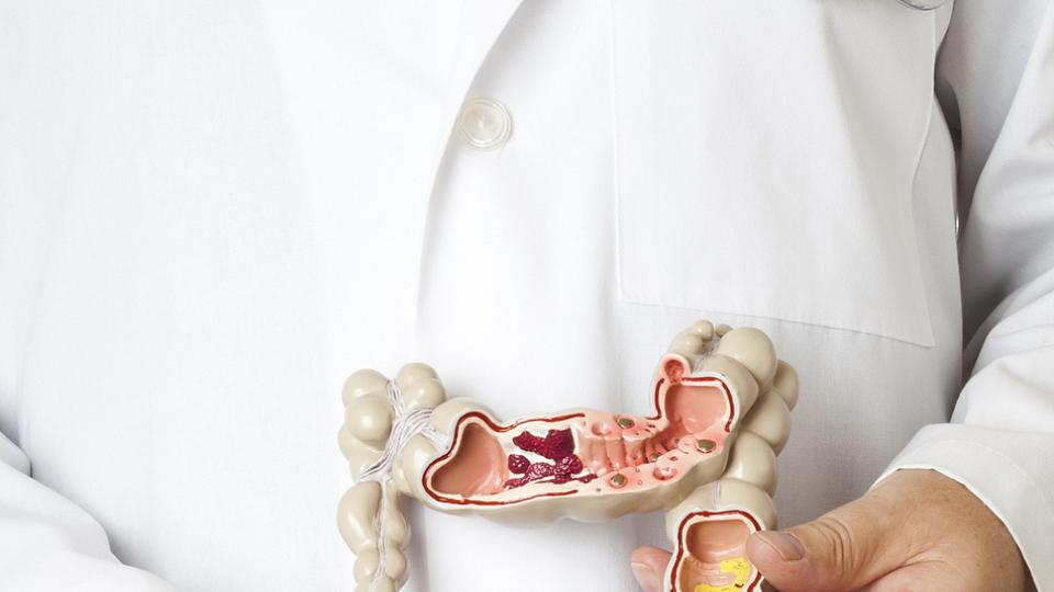 Understanding Colorectal Cancer Staging | AARO